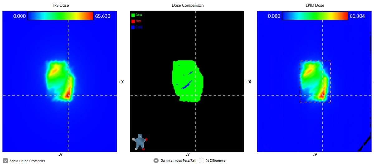 Patient Specific QA with Radformation's Robust Solutions